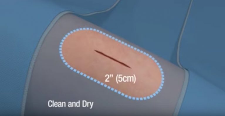 The 3M Steri Strips Are the Future of Stitches